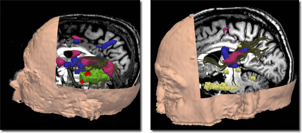 Multi-modality Language Mapping – Golby Lab