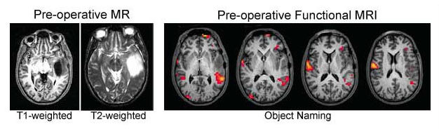 Multi-modality Language Mapping – Golby Lab